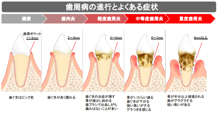 歯の奥が痛い原因6選！放置すると危険なサインと今すぐできる応急処置 - 陽光台ファミリー歯科クリニック